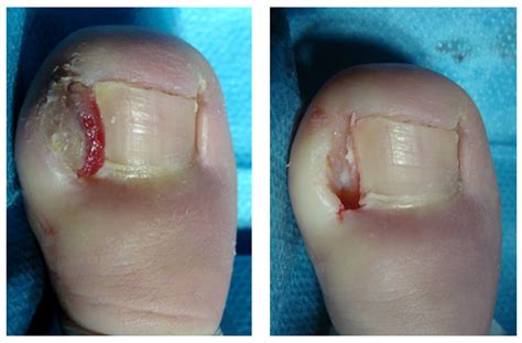 Hemostatic Efficacy Of Absorbable Gelatin Sponges For Surgical Nail