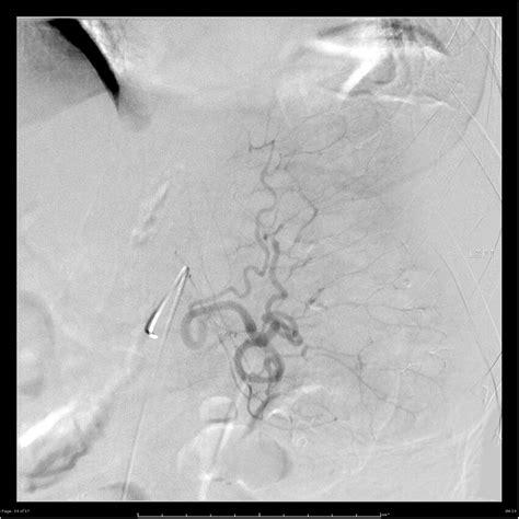 Radiopaedia Case Delayed Splenic Rupture Id 28571 Study 28825 Nc