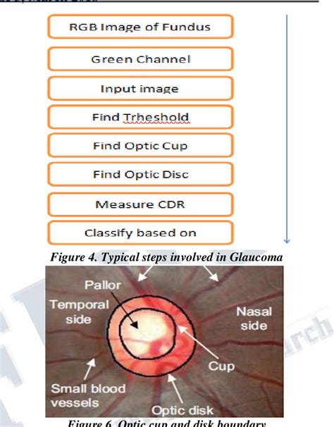 figure 4 from glaucoma detection and its classification using fuzzy c