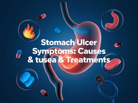 Stomach Ulcer Symptoms Causes And Peptic Ulcer Treatment Billboard