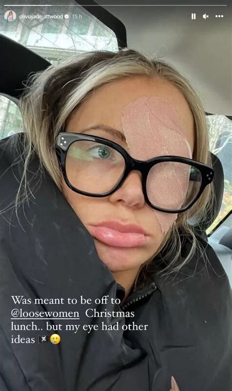 Loose Women Star Olivia Attwood Suffers Nasty Injury Meaning She Was
