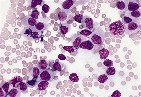 Monoblastic Leukemia