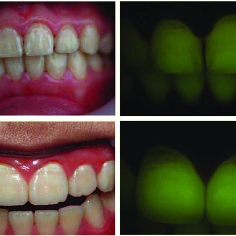 Smooth Surface Caries Detection Using Qlf Technology Taken From 6 Download Scientific