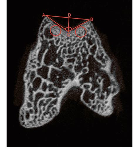 Measurement Diagram Dc Trochlear Depth Acb Sulcus Angle Download