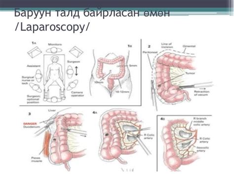 Бүдүүн гэдэсний хорт хавдар