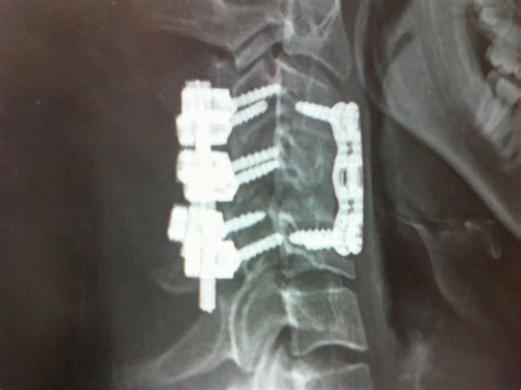 My Neck C3 C5 Fusion R Xrayporn