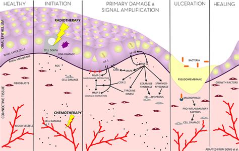 All About Oral Mucositis Symptoms Causes Treatment