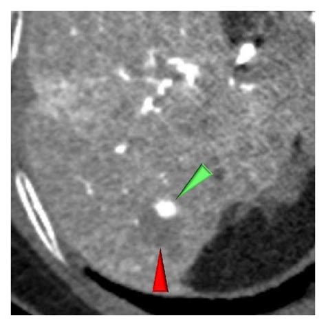 A High Grade Dysplastic Nodule Red Arrowheads Harboring A Progressed Download Scientific