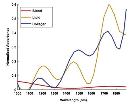 Intravascular Near Infrared Spectroscopy Predicts Heart Attacks Features Mayjun 2023