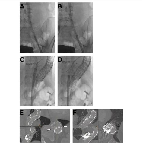 Pdf A Modified Candy Plug Technique To Occlude False Lumen In Aortic