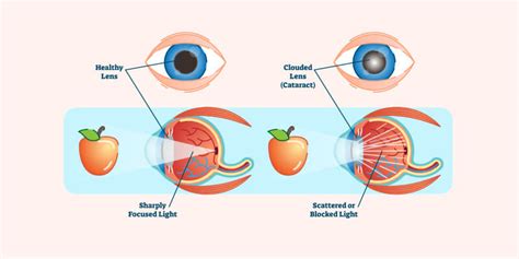 Understanding Working Lenses Cataract Types Diagnosis And Eye Care