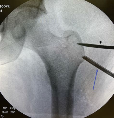 This Fluoroscopic Anteroposterior Image Of A Left Hip Shows The