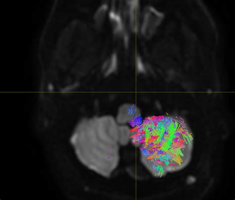 Tractography Pipeline Mrtrix3 Community