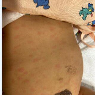 A Diffuse Flat Maculopapular Rash Developed On The Infant S Trunk Download Scientific Diagram