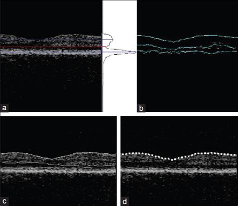 A Review Of Algorithms For Segmentation Of Optical Coherence Tomography From Retina Pmc