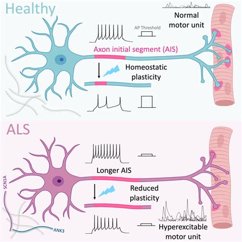 Specialised Motor Neuron Region Affected In Amyotrophic Lateral Sclerosis Kings College London