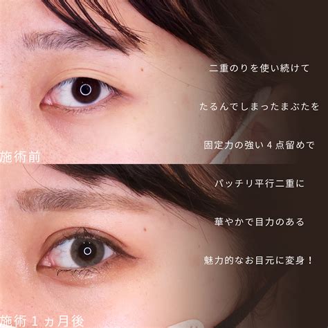 プチ整形で可愛い二重に 左右非対称な多重線まぶたを改善【埋没法】｜症例写真・ビフォーアフター｜美容整形･美容外科のtaクリニックグループ