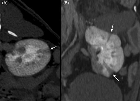 Faint And Wedge‐shaped Triangular Hypoattenuating And Hypoenhancing