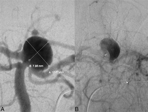 Ruptured Basilar Tip Aneurysm Before A And Immediately After B Download Scientific Diagram