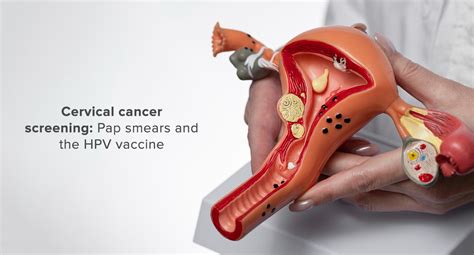 Cervical Cancer Screening Pap Smears And Hpv Vaccine Eternal Hospital