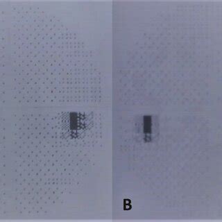 Visual Field Tests Demonstrating Normal Appearance In The Right A And