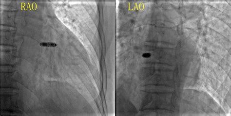 Typical Image Of The Leadless Pacemaker Implanted In The High