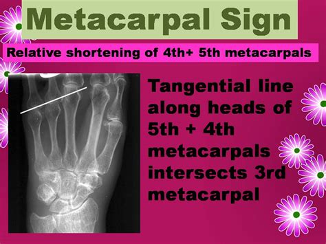 Carpal Angle Metacarpal Sign Radiology Classroom