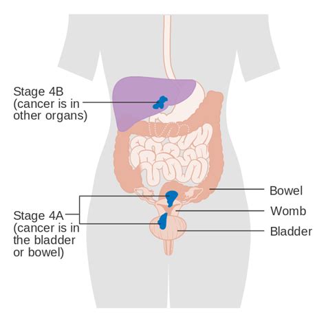 Stage 4 Endometrial Cancer Xpertpatient