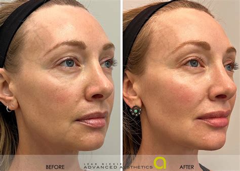 Nasolabial Fold Before And After