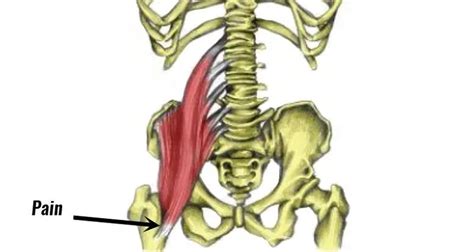 Hip Flexor Tendonitis Psoas Tendonitis Best Treatment Options Sheboygan Wi