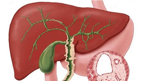 Primary Biliary Cholangitis Chronic Liver Disease
