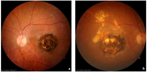 Congenital Toxoplasmosis Chorioretinitis