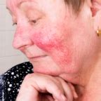 Malar Rash Difference Between