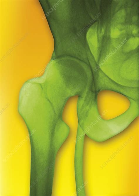 Normal Pelvic Veins Venogram Stock Image F0013016 Science Photo Library