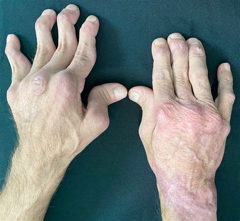 Pyoderma Gangrenosum Associated With Rheumatoid Arthritis