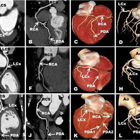 Coronary Dominance Patterns On Mpr And Vr Images Mpr Images A B And