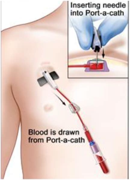 Chemo Ports Benefits Procedure And Risks