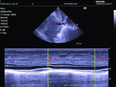 Inferior Vena Cava Collability İndex Measurement Download Scientific Diagram