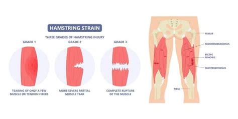 Proximal Hamstring Tear Recovery Time No Two Cases Are The Same