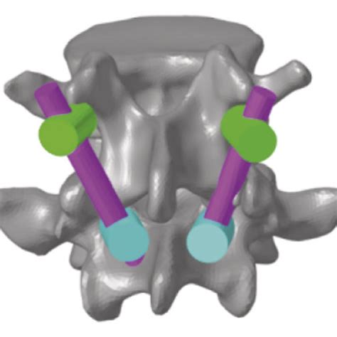 Finite Element Model Of The Lumber Vertebra And Diagrams Illustrating