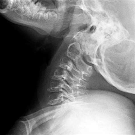 Spondyloepiphyseal Dysplasia Clinical Tree
