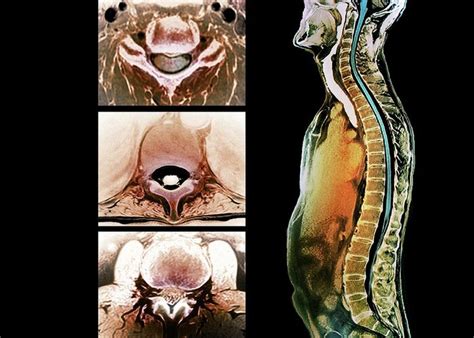 Backbone And Spinal Cord Anatomy 2 Greeting Card By Science Photo Library