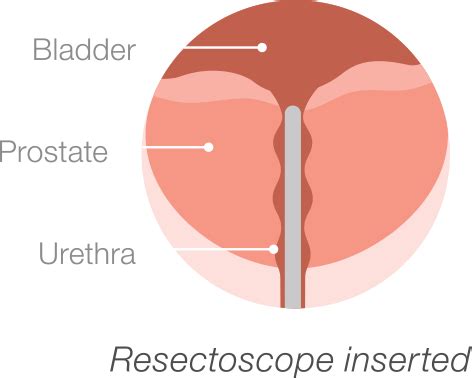 The Plasma Procedure Olympus Plasmabutton