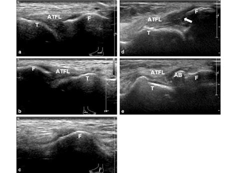 Examples Of The Normal And Injured Atfl A Sonogram Showed A Normal