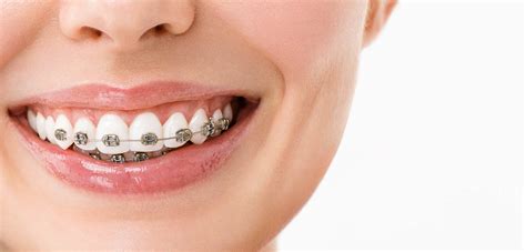 Dr Stosich Is An Elite Provider Of Suresmile Braces