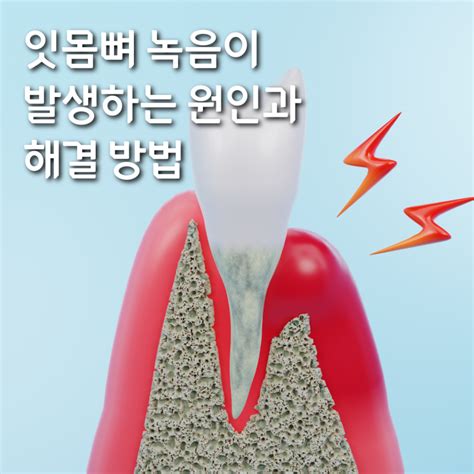잇몸뼈 녹음이 발생하는 원인과 해결 방법 네이버 블로그