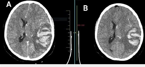 A Ct Brain Scan With Contrast Arrow Indicates The Sigmoid Sinus Download Scientific Diagram