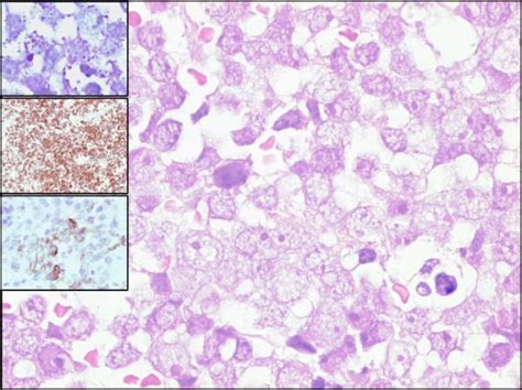 Tumor Section Hande Shows Loosely Arranged Medium Sized Cells With
