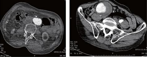 一 真性及假性动脉瘤 临床医师影像读片手册