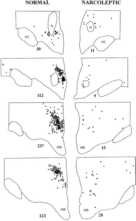 Reduced Number Of Hypocretin Neurons In Human Narcolepsy Neuron